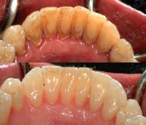 Paradentoza se može liječiti!