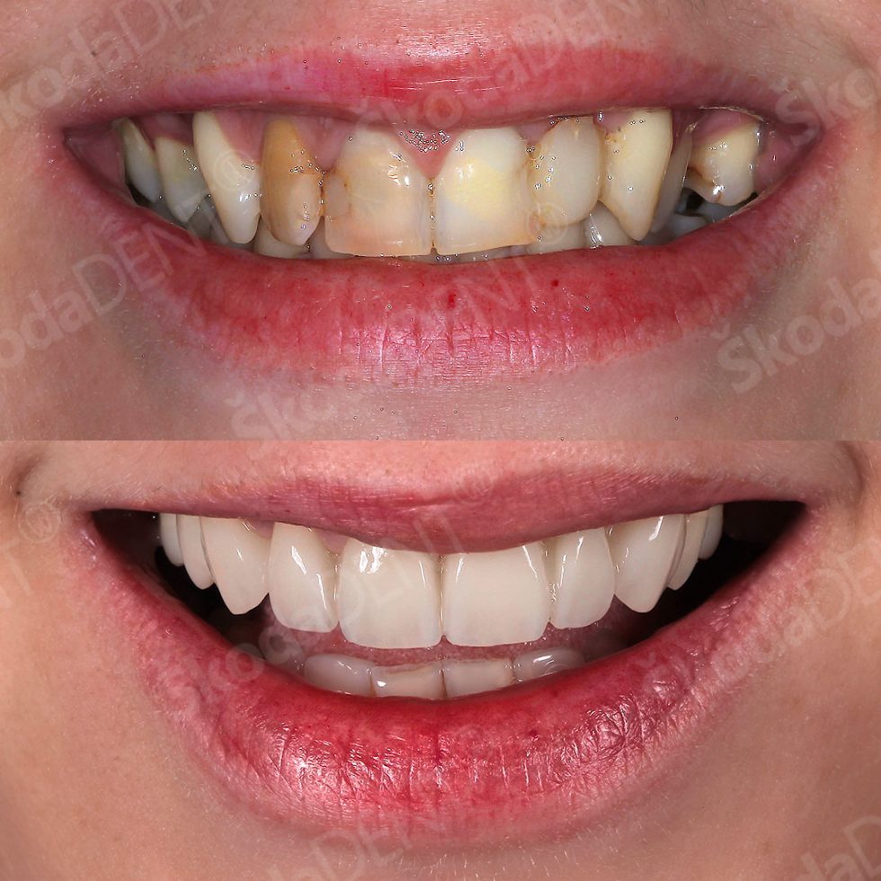 Zubne krunice - cirkonske i keramičke navlake za zube Rijeka